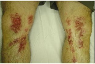 Electrocution and Its First Aid